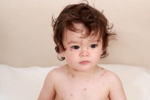 Reye Syndrome: Symptoms, Treatments and Potential Problems - Scope Heal