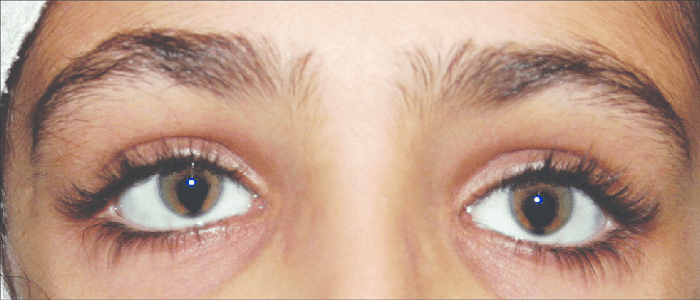 Acrocentric Chromosome: What is it? Function, Centromere and ...