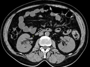 Angiomyolipoma: Types, Causes, Symptoms, Diagnosis, Treatment ...