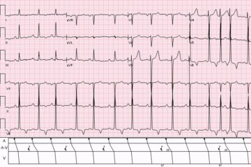 Anterior Left Hemiblock: Causes, Symptoms, Diagnosis and Treatment ...