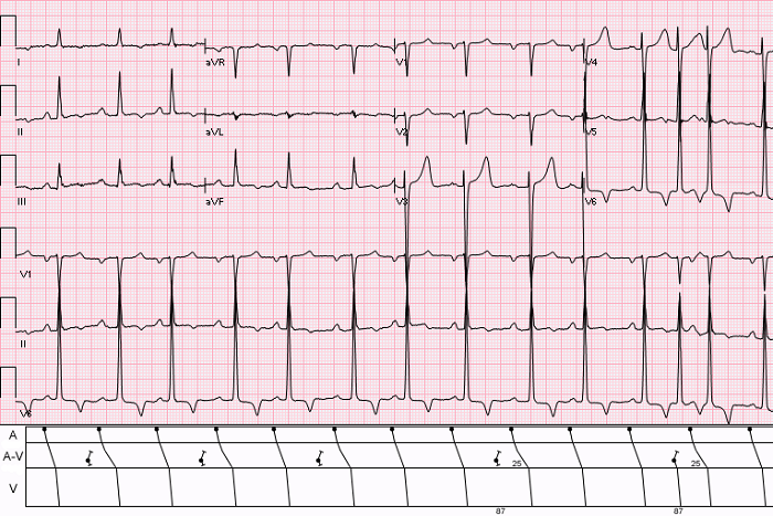 Anterior Left Hemiblock: Causes, Symptoms, Diagnosis and Treatment ...