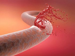 Arteriosclerosis: Symptoms, Causes, Treatment, Prevention and ...