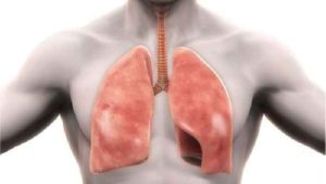 Atelectasis: Definition, Symptoms, Causes, Mechanisms, Diagnosis ...