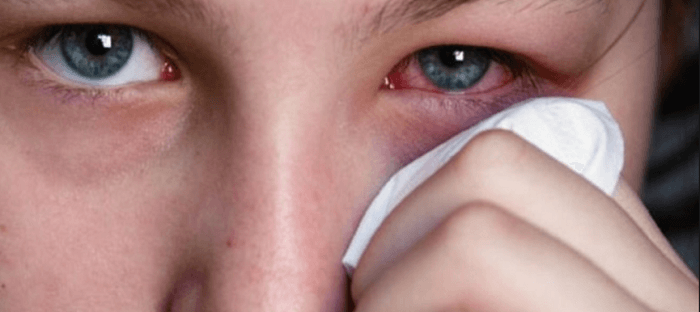 Behcet's Disease: Causes, Diagnosis and Risk Factors - Scope Heal