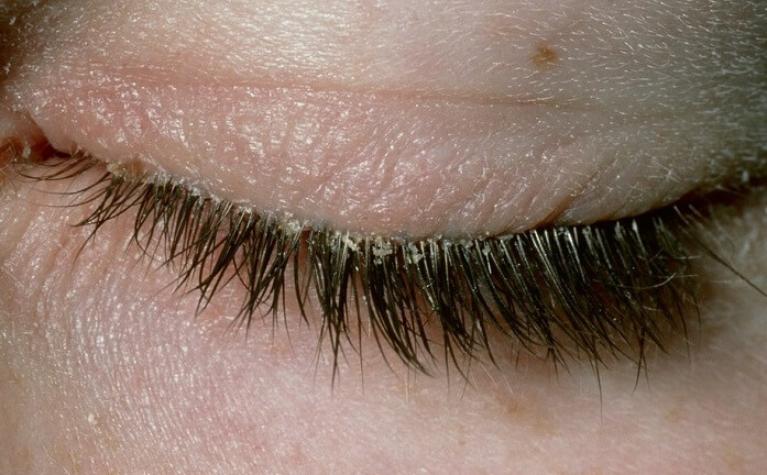 Blepharitis: Causes, Symptoms, Complications, Diagnosis, Treatment ...