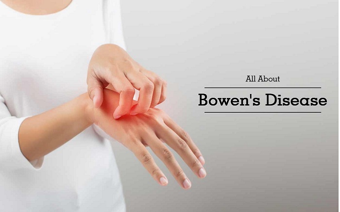 Bowen's disease: Causes, Symptoms, Diagnosis, Treatment, Prognosis and ...
