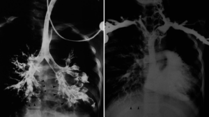 What is Bronchiectasis: Causes, Symptoms, Diagnosis and Treatment ...