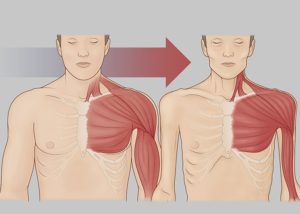 Cachexia: What is it? Causes, Symptoms, Risk Factors and Treatment ...