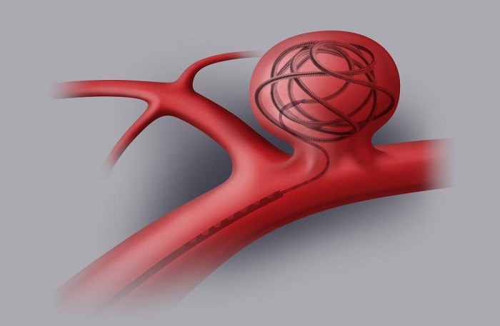 Cerebral Aneurysm: Symptoms and Diagnosis - Scope Heal