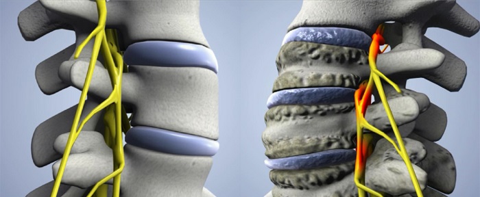 Degenerative Arthrosis: Causes, Symptoms and Treatments - Scope Heal