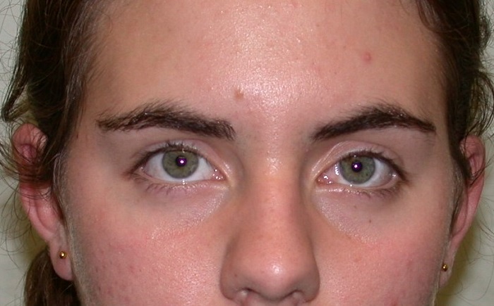 Divergent Strabismus: Classification, Causes, Symptoms, Diagnosis ...