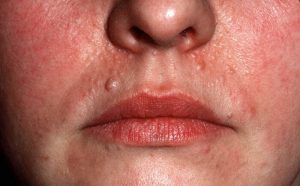 Epithelioma: Causes, Classification, Symptoms, Diagnosis, Treatment ...