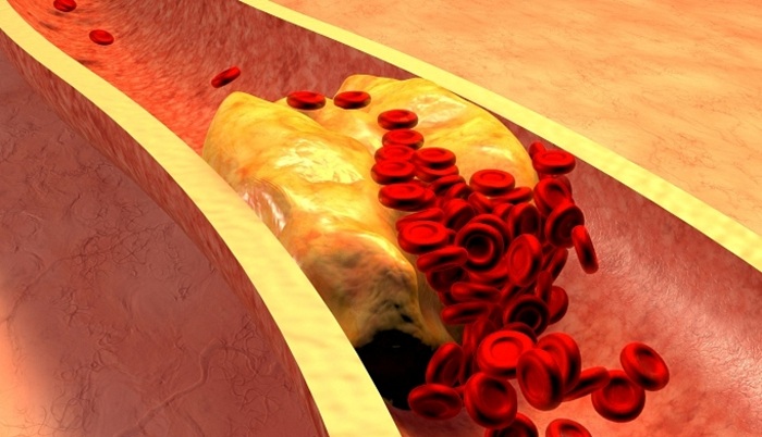 Familial Hypercholesterolemia: Definition, Causes, Symptoms, Diagnosis ...