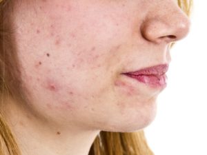 Folliculitis: Causes, Symptoms and Prevention - Scope Heal