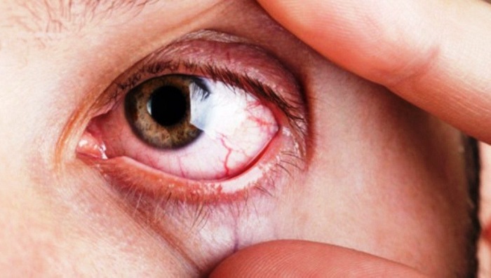Glaucoma: Causes, Types, Treatment and How to Detect It - Scope Heal