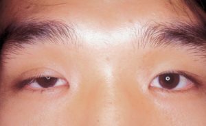 Horner syndrome: Causes, Symptoms, Diagnosis and Treatment - Scope Heal