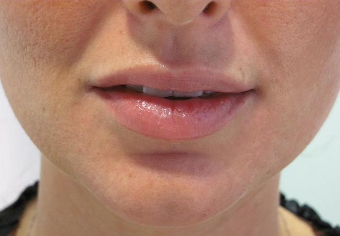 Hyaluronidase: What is it? Uses, Complications and Treatments - Scope Heal