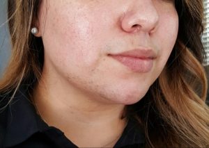 Hyperandrogenism: Definition, Causes, Signs, Symptoms, Diagnosis and ...