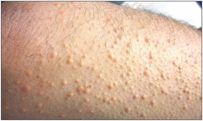 Hypertriglyceridemia: Symptoms, Diagnosis, Causes and Treatment - Scope ...