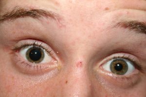 Hyphema: Symptoms, Causes, Classification, Treatment and Prevention ...