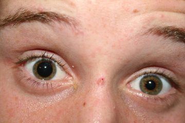 Hyphema: Symptoms, Causes, Classification, Treatment and Prevention ...