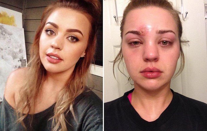 Infectious Cellulitis: Causes, Symptoms, Complications, Diagnosis ...