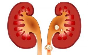 Kidney Lithiasis: Definition, Symptoms, Diagnosis and Treatment - Scope ...