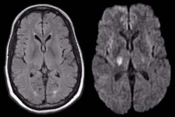 Lacunar infarction: What is it? Symptoms, Causes, Risk Factors ...