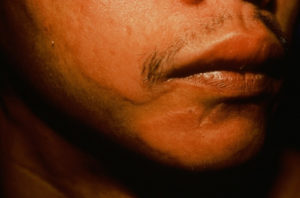 Leprosy: Causes, Risk Factors, Types, Symptoms, Diagnosis, Treatment ...