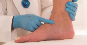 Lymphedema or Lymphatic Obstruction: Symptoms, Treatment, Tests and ...