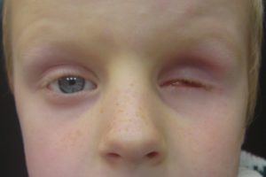 Microphthalmia: Definition, Causes, Diagnosis and Associated Conditions ...