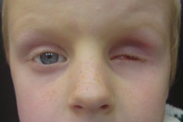 Microphthalmia: Definition, Causes, Diagnosis and Associated Conditions ...