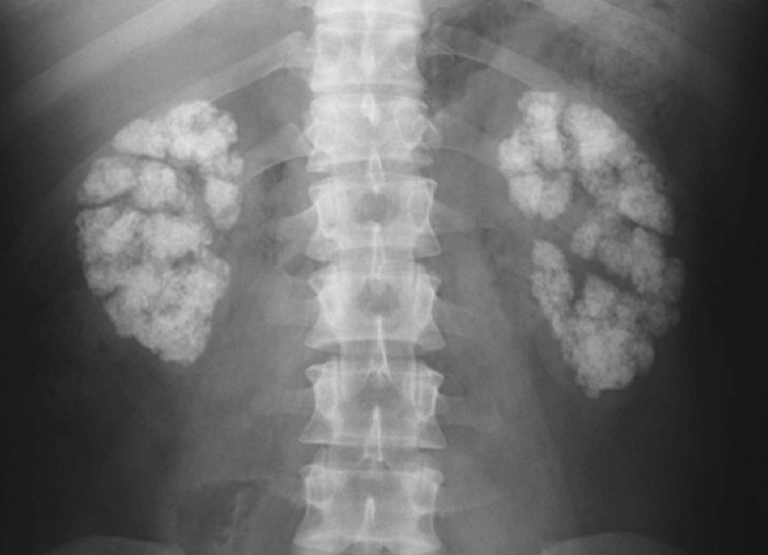 Nephrocalcinosis: Stages, Characteristics, Causes and Treatment - Scope ...