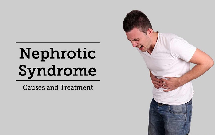 Nephrotic Syndrome: Diagnosis, Symptoms, Causes - Scope Heal