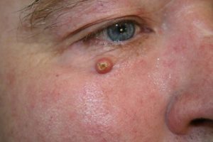 Nodule: Definition, Symptoms, Types, Causes, Diagnosis, Treatment and ...