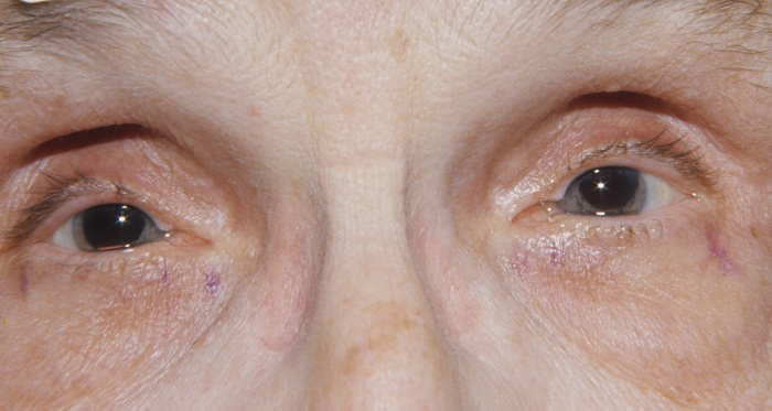 Ocular Effusion: Causes, Symptoms, Diagnosis, Treatment and Prevention ...