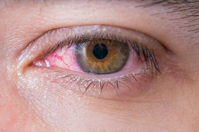 Ophthalmic Chloramphenicol: What is it? Presentations, Considerations ...