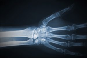 Osteopenia: Characteristics, Differences, Causes, Symptoms and ...