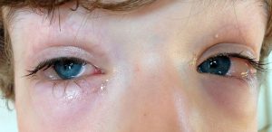 Palpebral Edema: Upper Eyelid, Lower Eyelid, Causes, Symptoms and ...