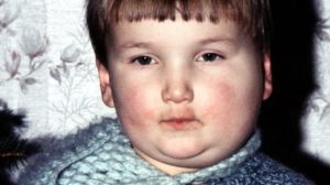 Parotiditis: Symptoms, Causes, Risk Factors and Treatment - Scope Heal