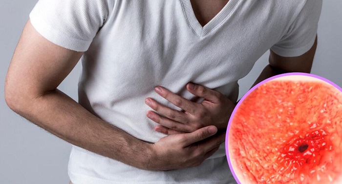 Peritonitis: Causes, Symptoms, Diagnosis, Treatment, Complications ...