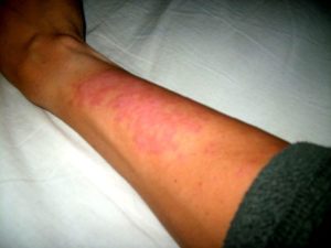 Photodermatitis: Symptoms, Causes, Diagnosis and Treatment Plan - Scope ...