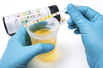 Proteinuria: What is it? Causes and Treatment - Scope Heal