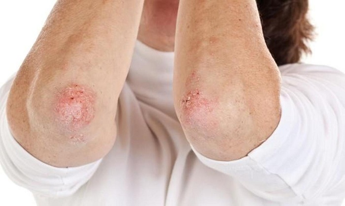 Psoriasis Guttata or Psoriasis in Drops: Symptoms, Causes and Treatment ...