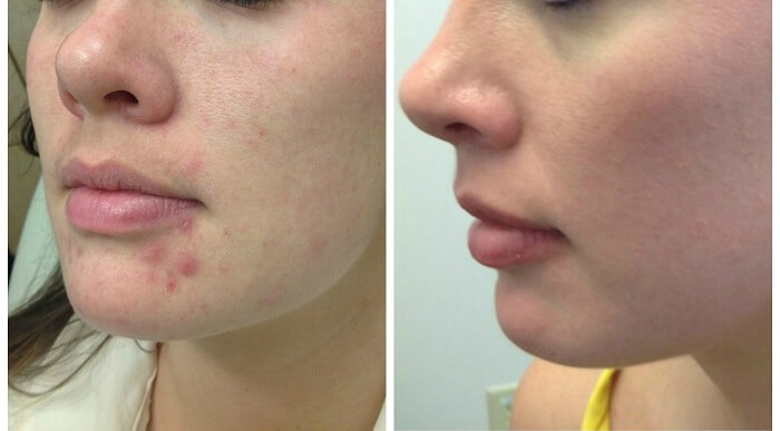 Roaccutan or Roaccutane: Uses, Contraindications, Side Effects and ...