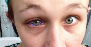 Sclera: Definition, Functioning, Associated Conditions and ...