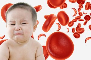 Sickle Cell Anemia: Causes, Diagnosis, Symptoms, Treatment and ...