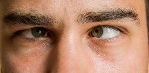 Strabismus - Strabismus: Causes, Symptoms, Types, Diagnosis, Associated ...