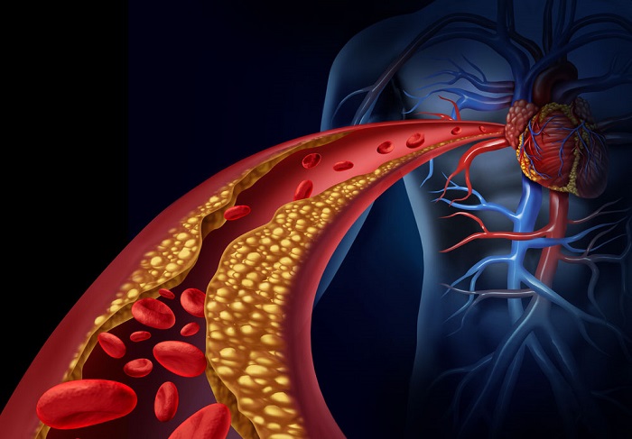 Atherogenic Index: Definition, Atherogenic Diet and Measurement of the ...
