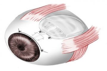 Trabeculectomy (Filtration Surgery) for Glaucoma: - Scope Heal